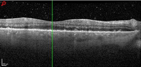 Macula Oct Of The Right Eye At The Initial Presentation There Are