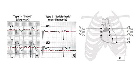 Brugada Syndrome Diagnosis
