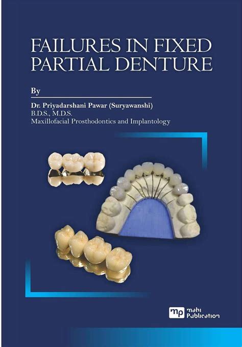 Failures In Fixed Partial Denture Dr Priyadarshani Pawar
