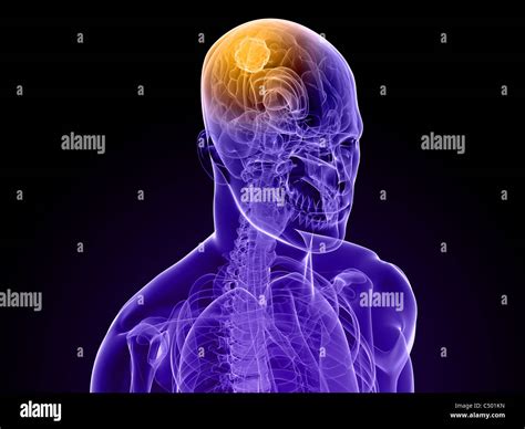 Brain Tumor Scan Hi Res Stock Photography And Images Alamy