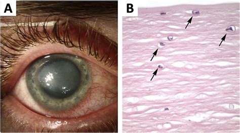 1a At Presentation Exam Showed 360° Of Ciliary Flush And A 5 × 6 Mm