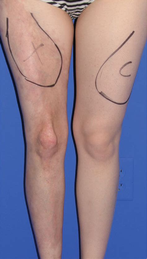 Figure 2 1 From Chapter 2 Localized Scleroderma Semantic Scholar