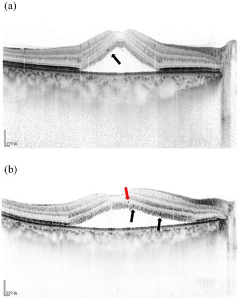 Hrf On Oct A Hrf In Outer Segment Photoreceptor Layer Black Arrow Download Scientific