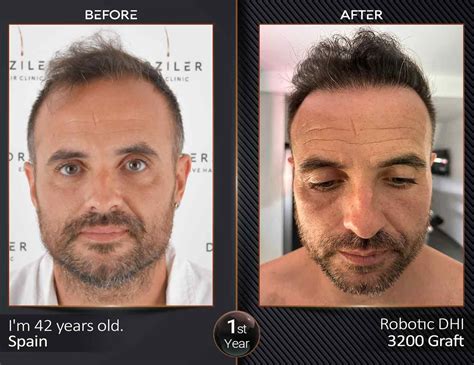 What Is Androgenetic Alopecia Understanding Causes Symptoms And