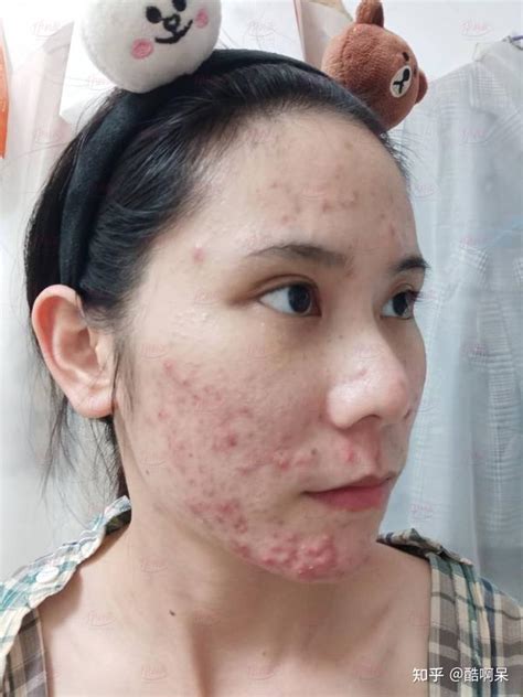 油痘肌专业课程1 有一种毁容叫长痘没长过的人永远不懂有多痛 知乎