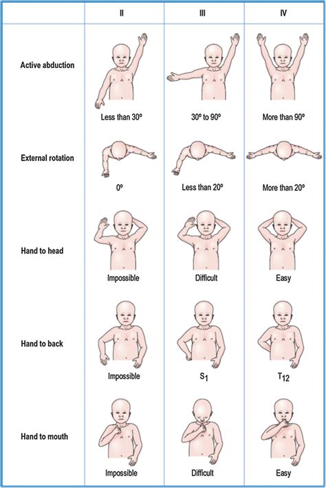 Mallet Classification Brachial Plexus At Jorge Damon Blog