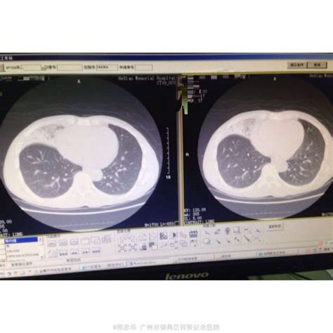 肺结核1例 医联