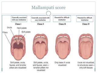 Obstructive Sleep Apnea Pptx