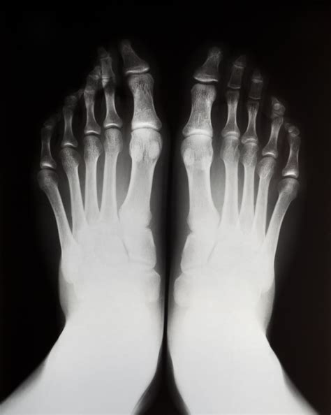 Radiografía De Los Pies Izquierdo Y Derecho Foto Premium