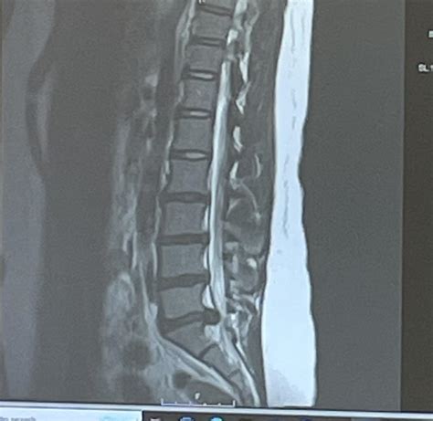 234 Best Rsciatica Images On Pholder L5 S1 Disc Herniation Mri