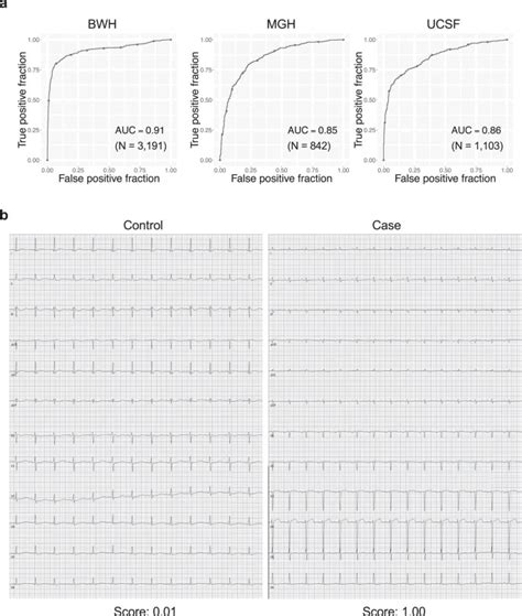 Using Artificial Intelligence To Detect Cardiac Amyloidosis