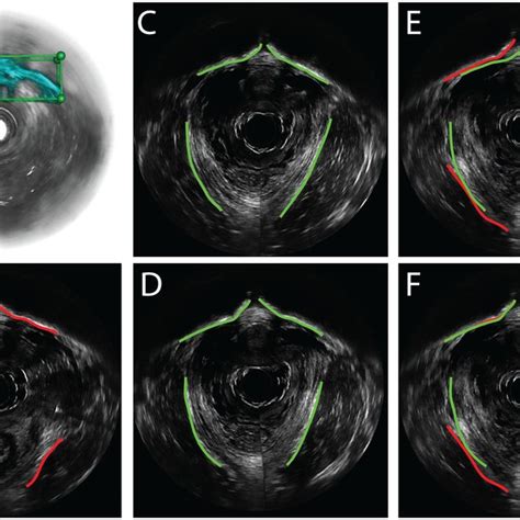 Intensity Based Volumetric Registration On Pubic Bone Voi A A Cubic