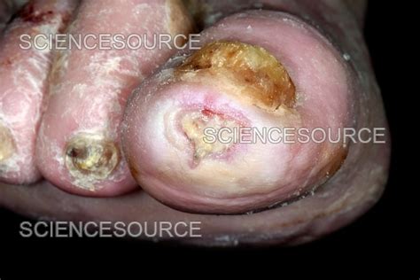 Toe Ulcer In Diabetes Stock Image Science Source Images