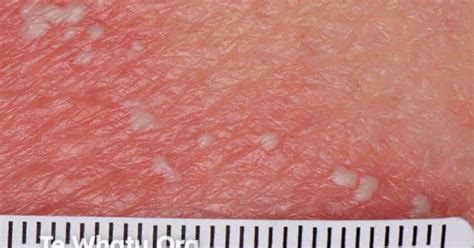Generalised Pustular Psoriasis Image
