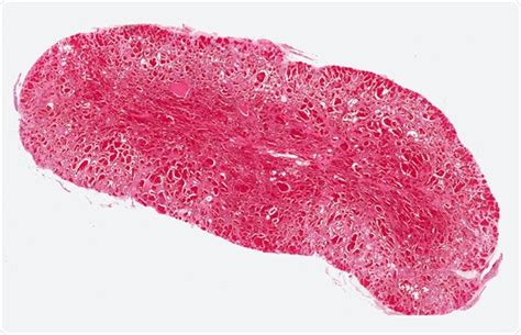 Angiosarcoma Diagnosis