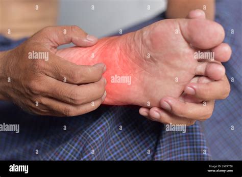 Itchy Foot Skin Of Asian Young Man Concept Of Skin Diseases Such As