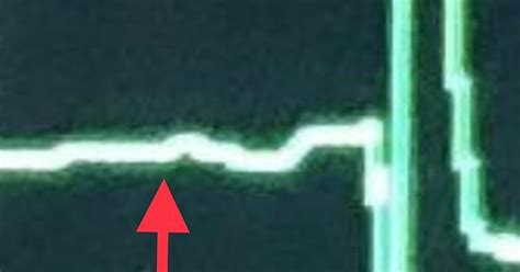 Biphasic P Wave Album On Imgur