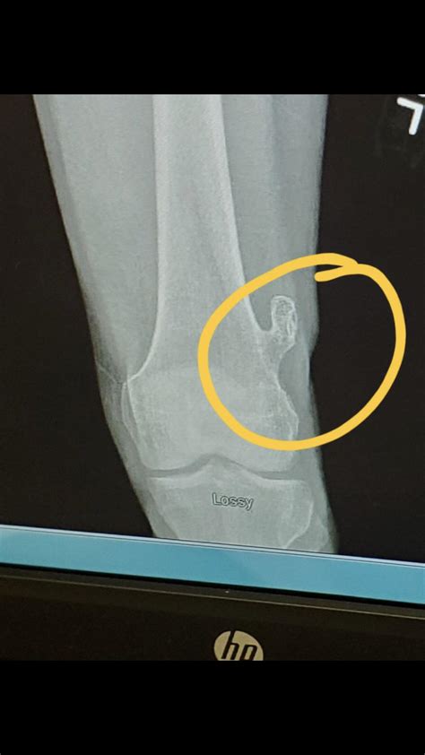 This Weird Growth On The Pals Femur R Mildlyinteresting