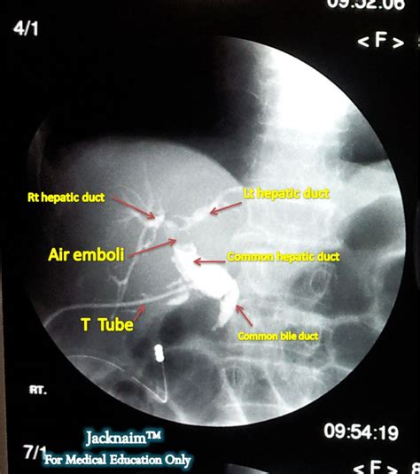 Cholangiogram