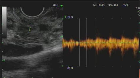 Eus Power Wave Doppler Identification Of Splenic Pseudoaneurysm