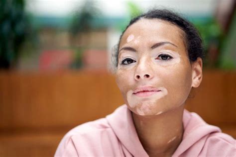Día Mundial Del Vitiligo Qué Es Y Por Qué Se Conmemora