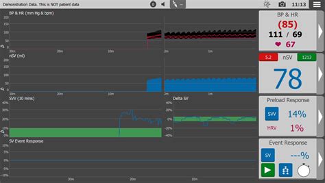  Lidco Hemodynamic Monitoring For The Entire Patient Pathway