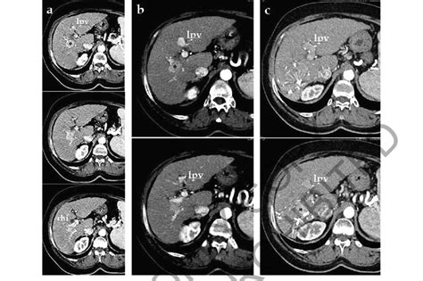 A The Preoperative Ct Scan Of The Abdomen Shows A 26x23 Mm Solid Mass Download Scientific