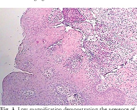Figure 1 From Pyostomatitis Vegetans Report Of A Rare Case Semantic