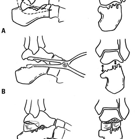 A Talo Calcaneal Height B Talo Calcaneal Angle C Talar Declination