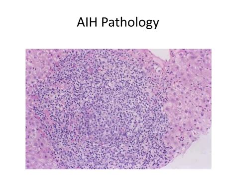 Autoimmune Hepatitis Update 2021 Powerpoint Ppt