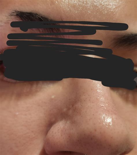 How Can I Get Rid Of Bumpy Acne Scarring On My Nose R Skincareaddicts