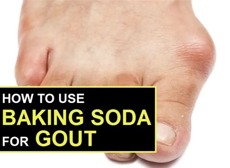 Baking Soda For Gout Does It Work