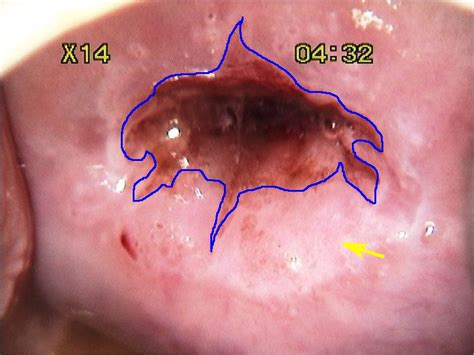 Colposcopy Digital Atlas