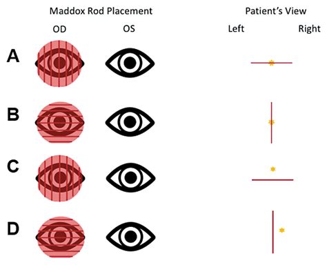 Superior Oblique Palsy Diplopia Charting