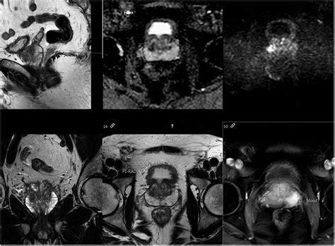 Comparison Of Bi And Multiparametric Magnetic Resonance Imaging To Select Men For Active