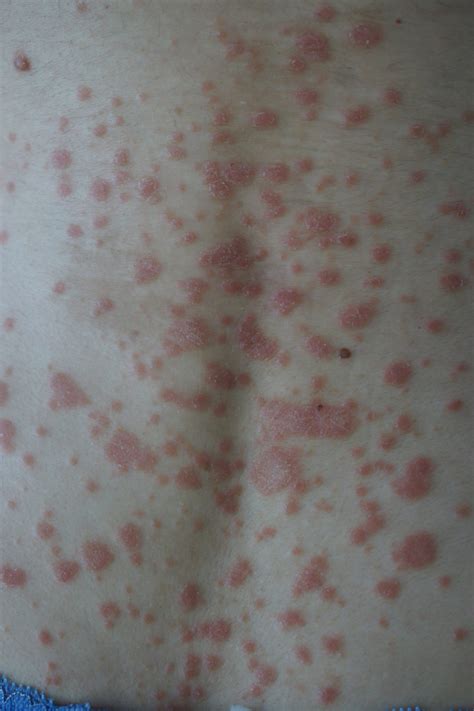 Treatments For Inverse Guttate Pustular And Erythrodermic Psoriasis Psoriasis Cure Now