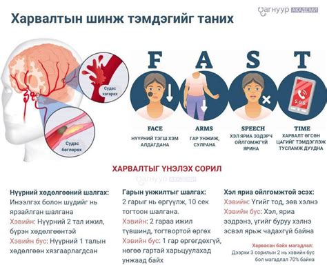 Анхны Цус харвалтын үед илрэх шинжүүд болон үнэлэх аргыг мэдээд аваарай Харвалтын үед илрэх