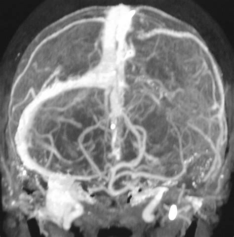Cerebral Venous Thrombosis And Multidetector Ct Angiography Tips And