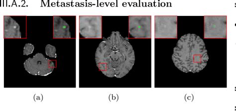 Figure 4 From Deep Learning For Brain Metastasis Detection And Segmentation In Longitudinal Mri