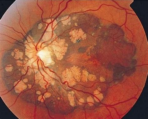 Peripapillary Chrpe A Pathology Study Zahra Medicare Posted On The