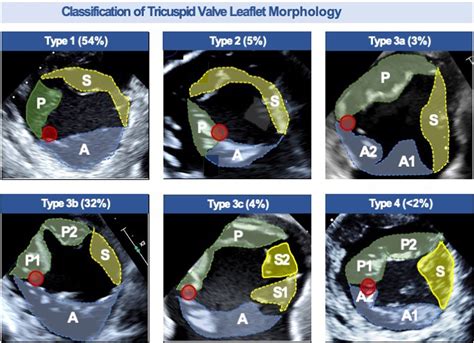Key Echocardiographic Considerations For Tricuspid Valve Transcatheter