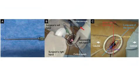 Tips For Using Forceps During Uniportal Video Assisted Thoracoscopic