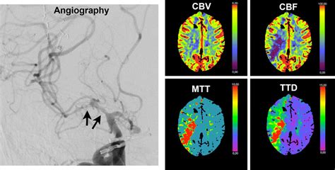 Example Of A 58 Year Old Patient With Cerebral Vasospasm 5 Days After Download Scientific
