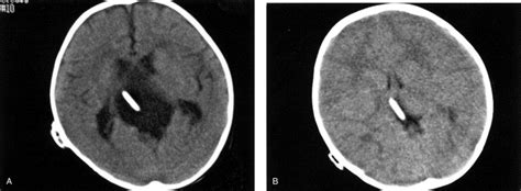 Quadrigeminal Cistern Arachnoid Cyst In A Patient With Kabuki Syndrome
