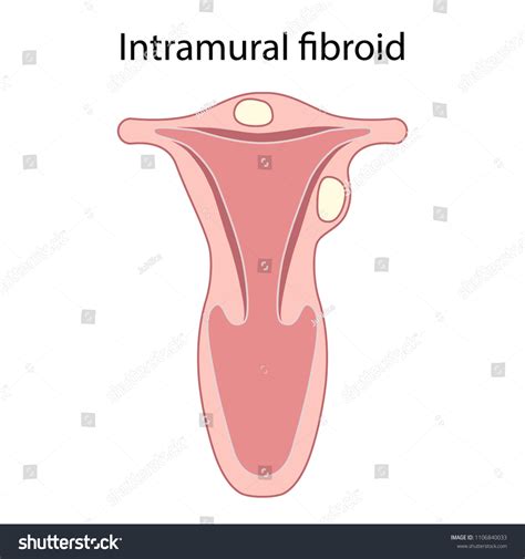 Intramural Fibroidfemale Reproductive Organ Pathology Benign 스톡 벡터 로열티
