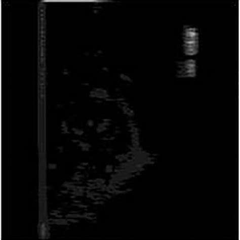 Breast Cancer Detection Work Flow Using Gabor Transform Based Cnn Download Scientific Diagram