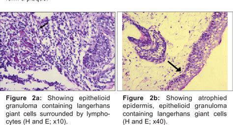 Figure 2 From Unusual Presentation Of Scrofuloderma In An Immunocompetent Patient Semantic