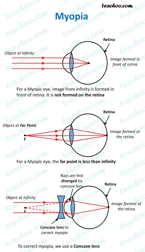 Defects Of Vision Myopia Hypermetropia Presbyopia Teachoo