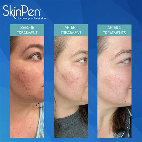Microneedling Jordan Valley Dermatology Center Dermatologist In