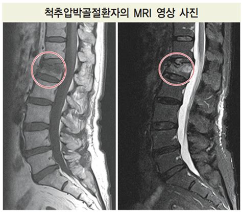 골다공증과 척추압박골절